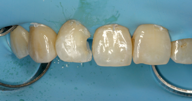 Ästhetische Optimierung eines devitalen Frontzahnes – ZWP online – das ...