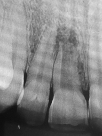 Therapiemöglichkeit einer Pulpanekrose – ZWP online – das ...
