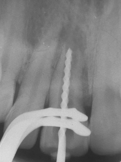 Therapiemöglichkeit einer Pulpanekrose – ZWP online – das ...
