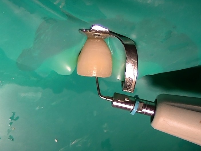 Therapiemöglichkeit einer Pulpanekrose – ZWP online – das ...