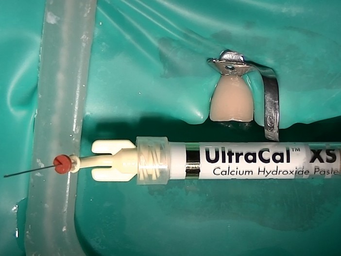 Therapiemöglichkeit einer Pulpanekrose – ZWP online – das ...