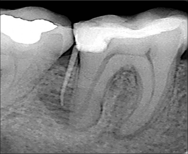 Mikroskopunterstützte Revisionsbehandlung – ZWP online – das ...