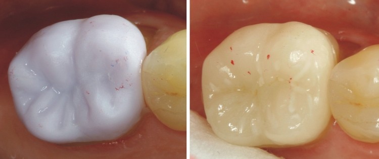 Teilkronen aus Keramik – ein Therapiekonzept im Fluss – ZWP online ...