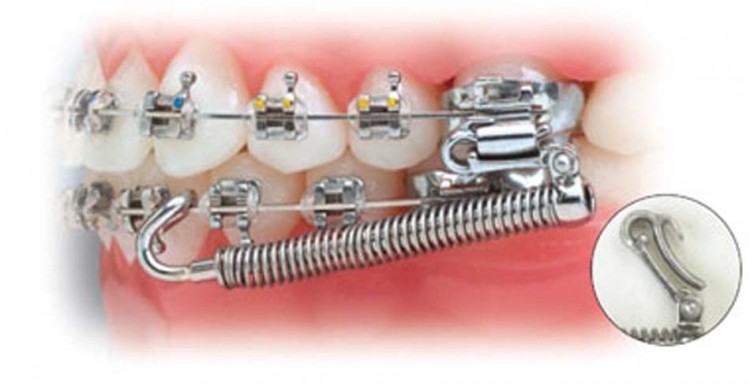 Forsus-Feder in Kombination mit der Lingualtechnik – ZWP online – das ...