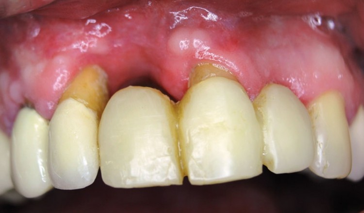 Vertikale Distraktionsosteogenese des Alveolarfort – ZWP online – das ...