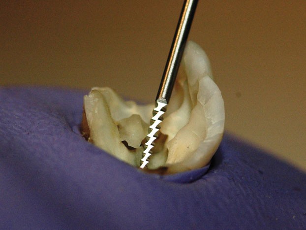 SafeSiders are good 4u – Eine effektive Kanalaufbereitung – ZWP online ...