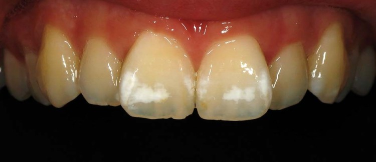 Fluoroseinfiltration bei einer jungen Patientin – ZWP online – das ...