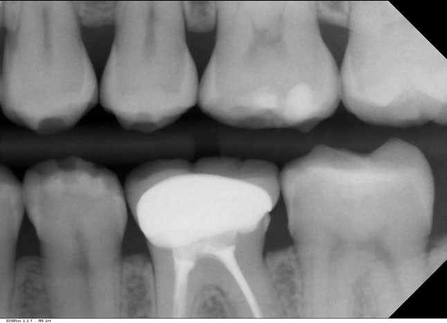 Approximalkaries schonend und frühzeitig erkennen – ZWP online – das ...
