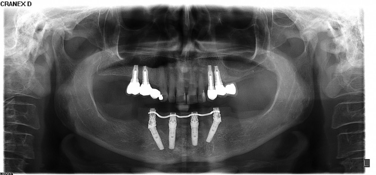 Sicherheit und Vorhersagbarkeit in der modernen Implantologie – ZWP ...