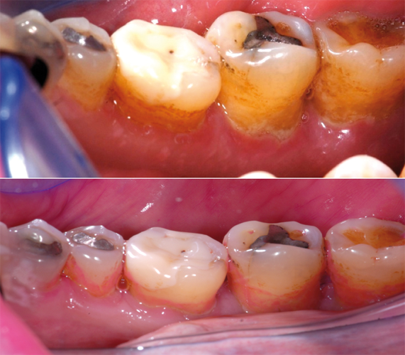 Refraktäre Parodontitis – Problematische Diagnose und Therapie – ZWP online – das ...