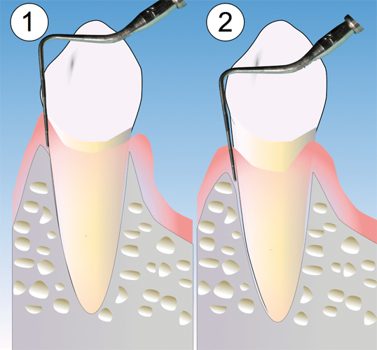 Refraktäre Parodontitis – Problematische Diagnose und Therapie – ZWP online – das ...