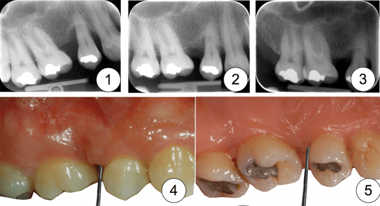 Refraktäre Parodontitis – Problematische Diagnose und Therapie – ZWP online – das ...