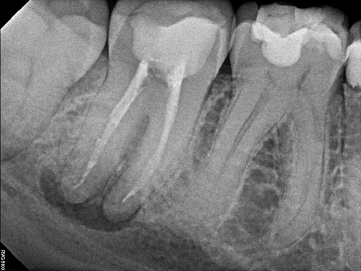 Optimiertes Aufbereitungskonzept für die Endodontie – ZWP online – das ...