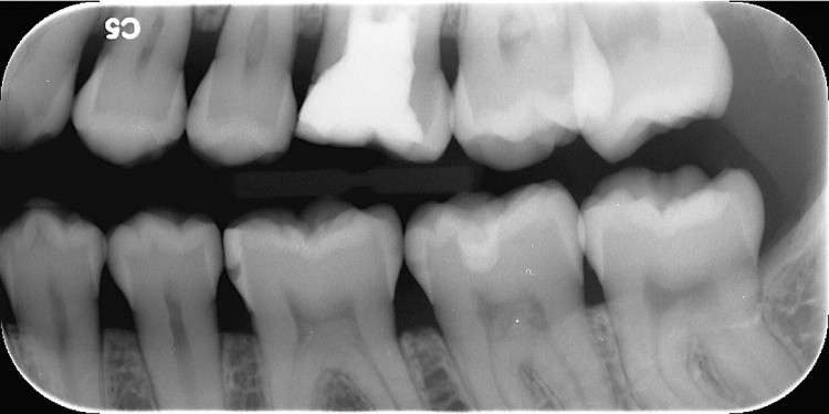 Mikroinvasivität durch Kariesinfiltration – ZWP online – das ...