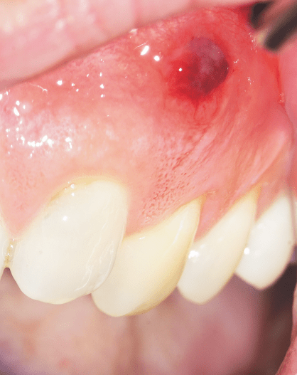 Diagnostik und Therapie eines Dens invaginatus – ZWP online – das ...