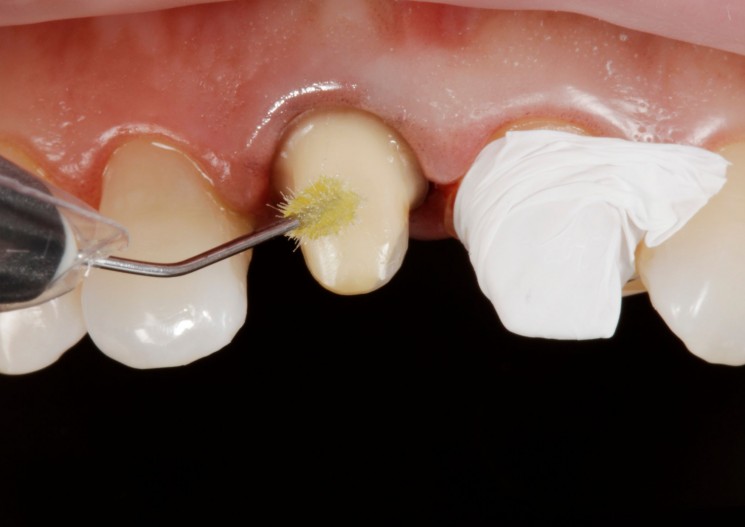 Universaladhäsive: Ein Adhäsiv für alle Indikationen – ZWP online – das ...