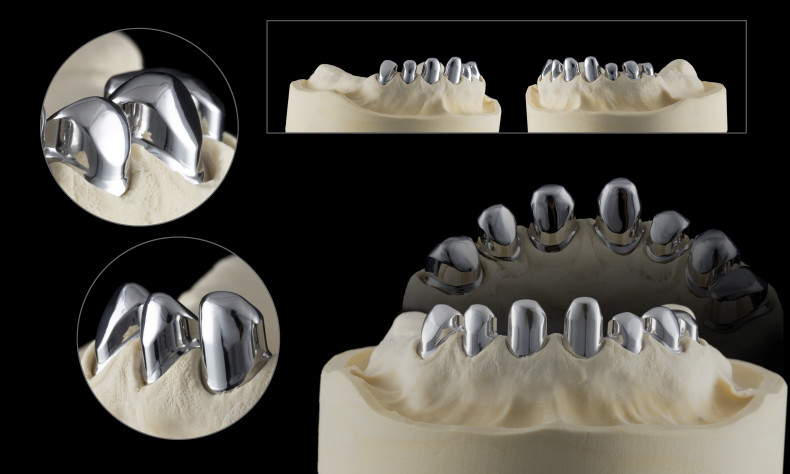 Heavy Metal Teil 3 – Teleskop-Passung in Perfektion – ZWP online – das ...