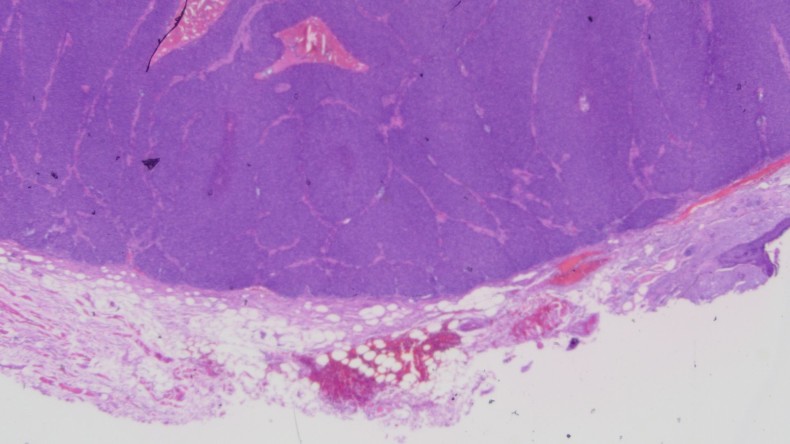 Basalzellkarzinome an der Grenze von Lippenrot und Lippenweiß – ZWP ...