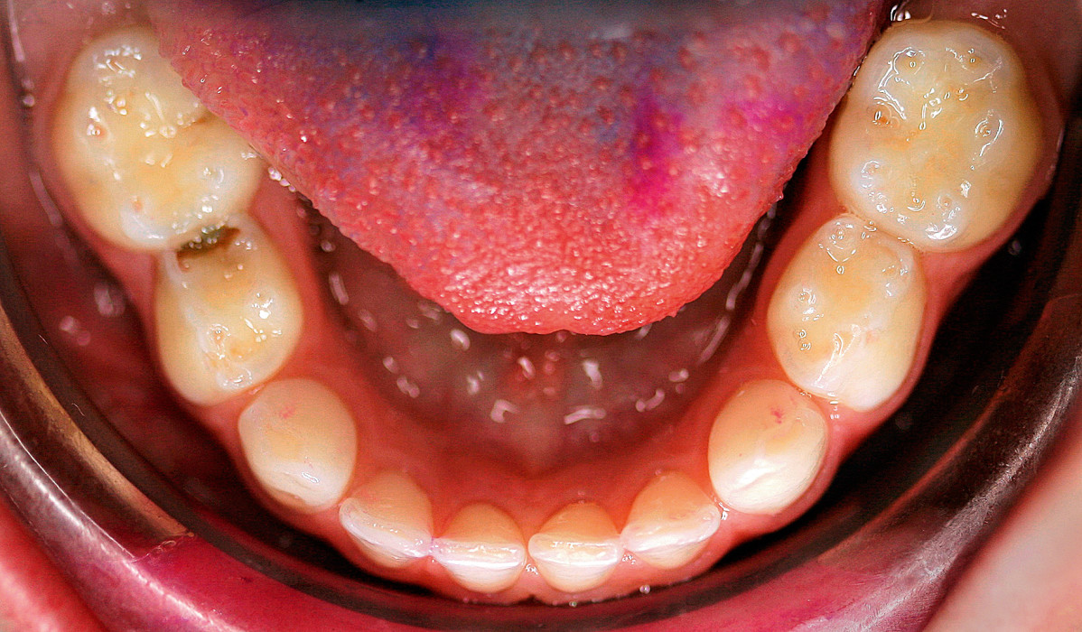 Frühkindliche Karies – Ein Überblick – ZWP online – das ...