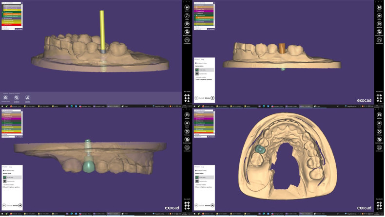 Sofortimplantation und Sofort­versorgung mit neuer Präzision – ZWP online – das ...