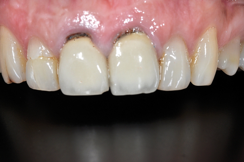 Gesteuerte Knochenregeneration – „One Time Therapy“ – ZWP online – das ...