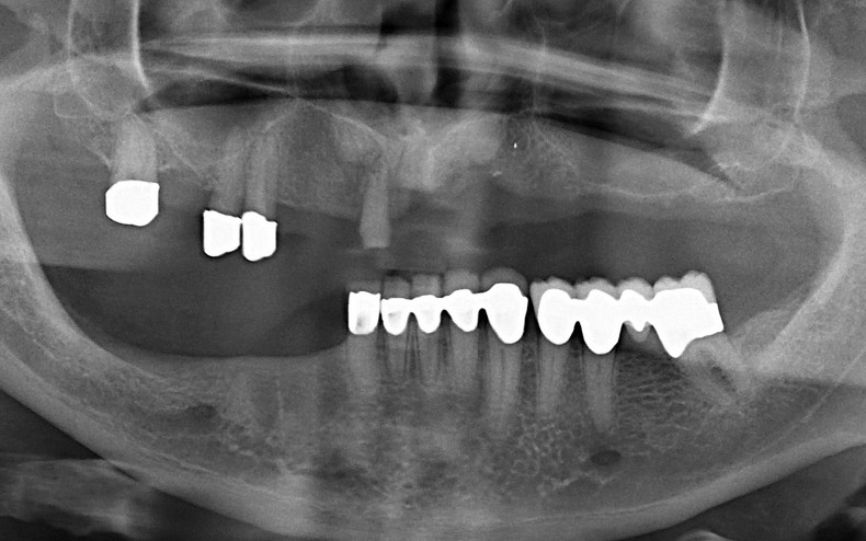 Neuimplantation und vertikaler Knochenaufbau – ZWP online – das ...