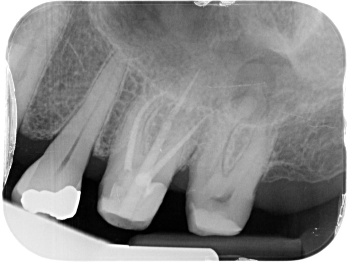 Einfache Kanalaufbereitung für Allrounder und Spezialisten – ZWP online ...