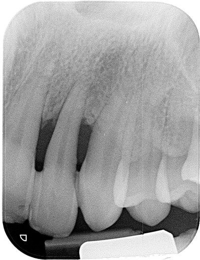 Parodontitisbehandlung: Lokalantibiotikum als Therapieergänzung – ZWP ...