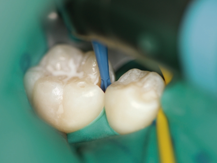 Herausforderung: Exkavieren im Milch- und juvenilen Gebiss – ZWP online ...