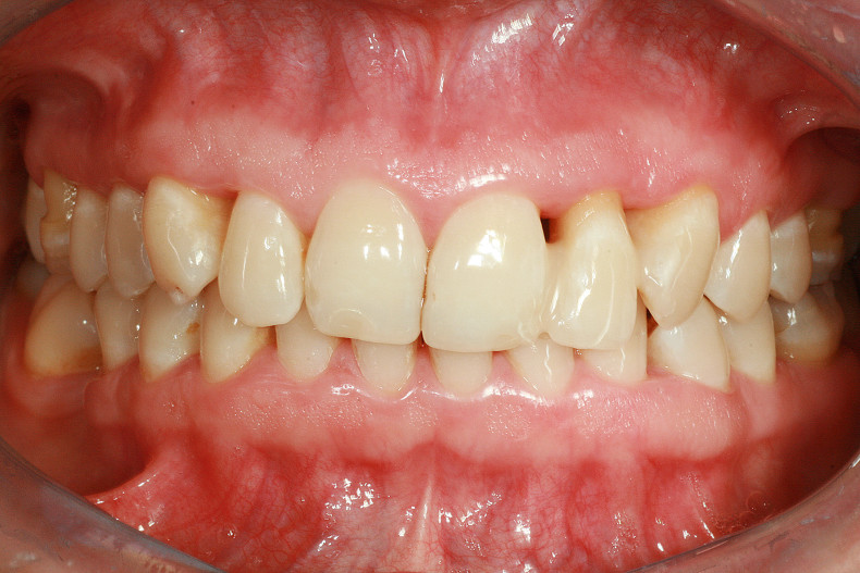 Parodontitisbehandlung: Lokalantibiotikum als Therapieergänzung – ZWP ...