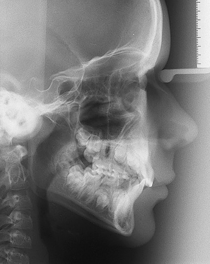 Ist der Headgear heute noch aktuell oder ein Auslaufmodell? – ZWP ...