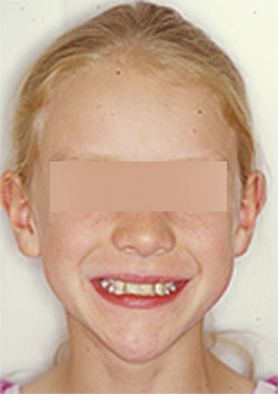 Ist der Headgear heute noch aktuell oder ein Auslaufmodell? – ZWP ...