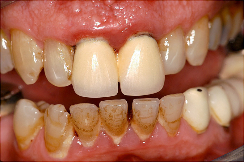 Prävention oraler Leiden bei schweren Allgemeinerkrankungen – ZWP ...