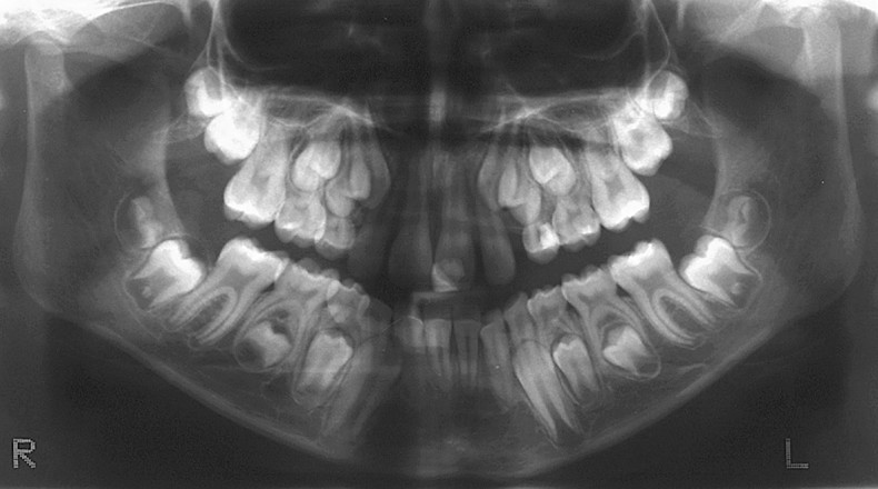 Ist der Headgear heute noch aktuell oder ein Auslaufmodell? – ZWP ...