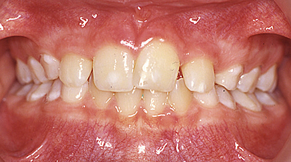 Ist der Headgear heute noch aktuell oder ein Auslaufmodell? – ZWP ...