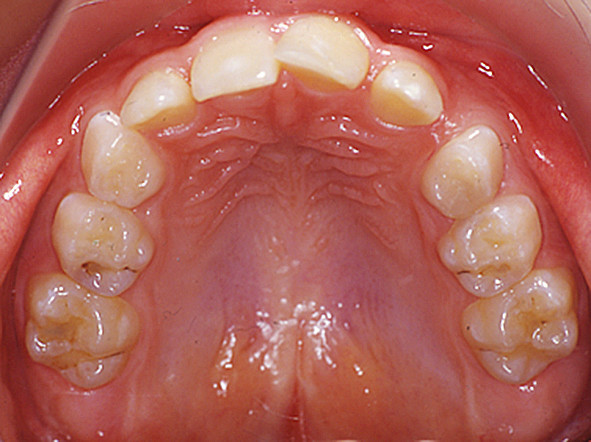 Ist der Headgear heute noch aktuell oder ein Auslaufmodell? – ZWP ...