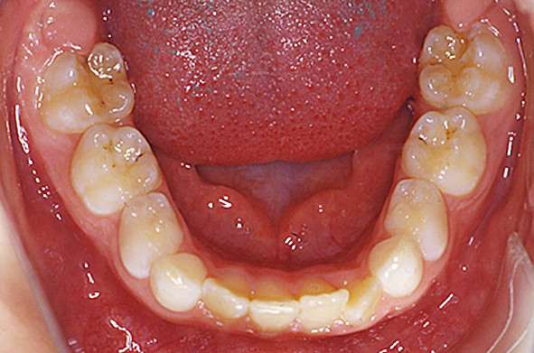 Ist der Headgear heute noch aktuell oder ein Auslaufmodell? – ZWP ...