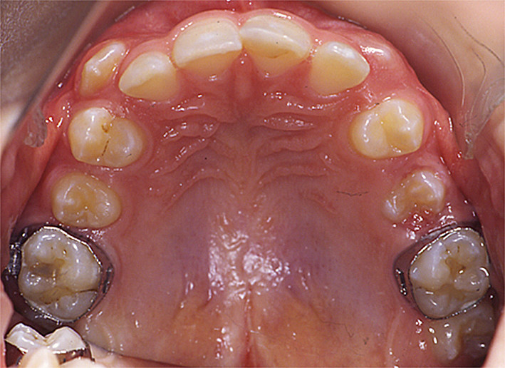 Ist der Headgear heute noch aktuell oder ein Auslaufmodell? – ZWP ...