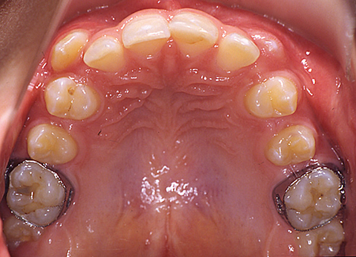 Ist der Headgear heute noch aktuell oder ein Auslaufmodell? – ZWP ...
