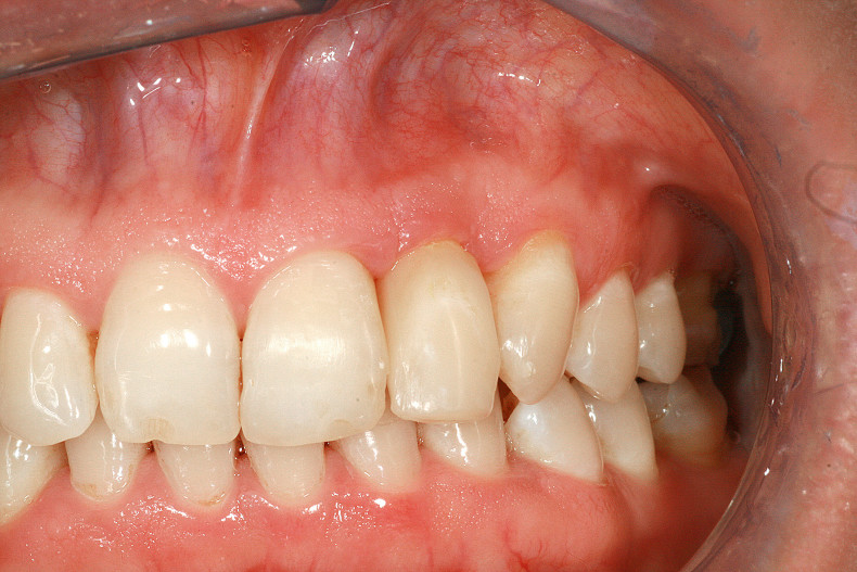 Parodontitisbehandlung: Lokalantibiotikum als Therapieergänzung – ZWP ...