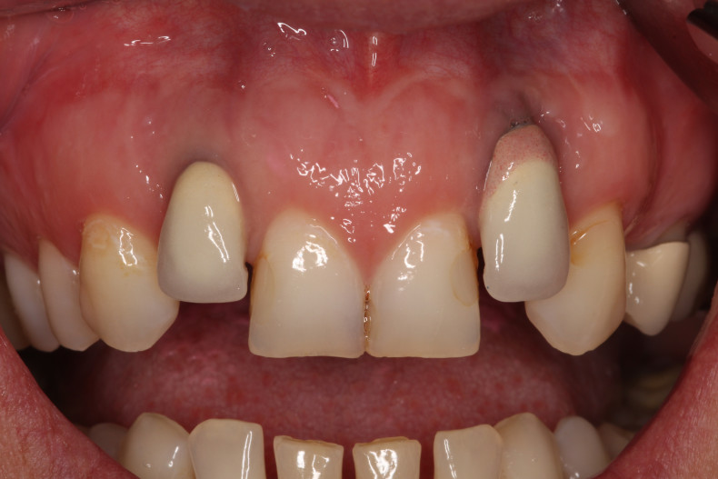 Behandlungsfall: Implantation im späten Kindesalter? – ZWP online – das ...