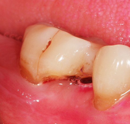 Schienungen im parodontal kompromittierten Gebiss – ZWP online – das ...