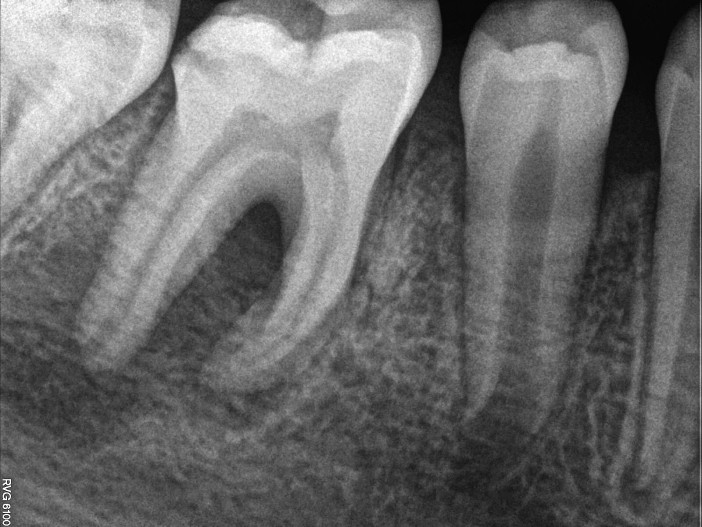 Apikale Läsion – behandeln oder nicht? – ZWP online – das ...