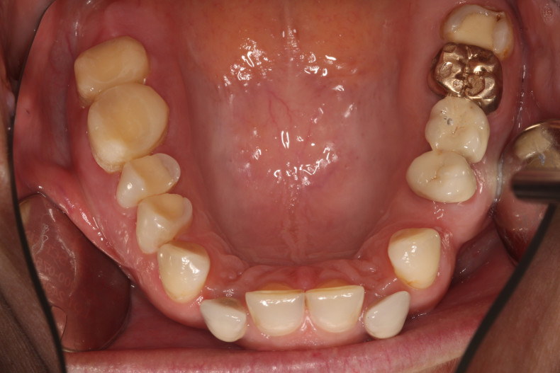 Behandlungsfall: Implantation im späten Kindesalter? – ZWP online – das ...
