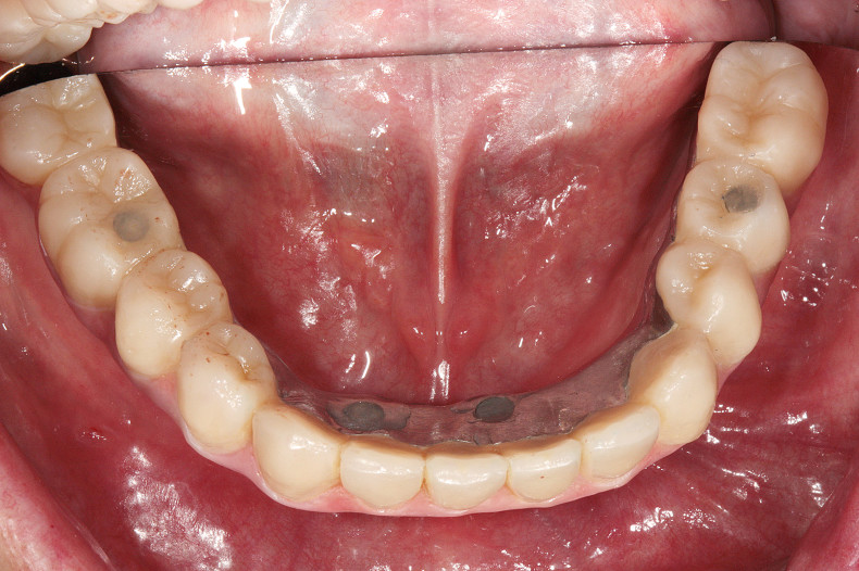 Extensionen bei Implantatsuprastrukturen – ZWP online – das ...