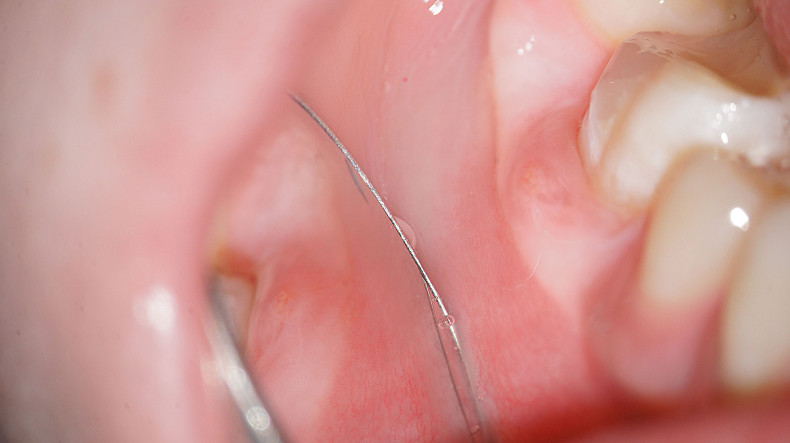 Apikale Läsion – behandeln oder nicht? – ZWP online – das ...