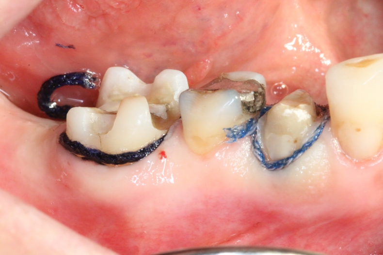 Intraligamentäre Anästhesie mit adrenalinfreiem Articain – ZWP online ...