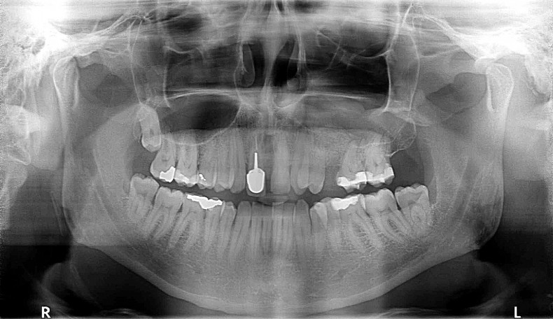 Einzelzahnimplantat mit Weichgewebeaufbau – ZWP online – das ...