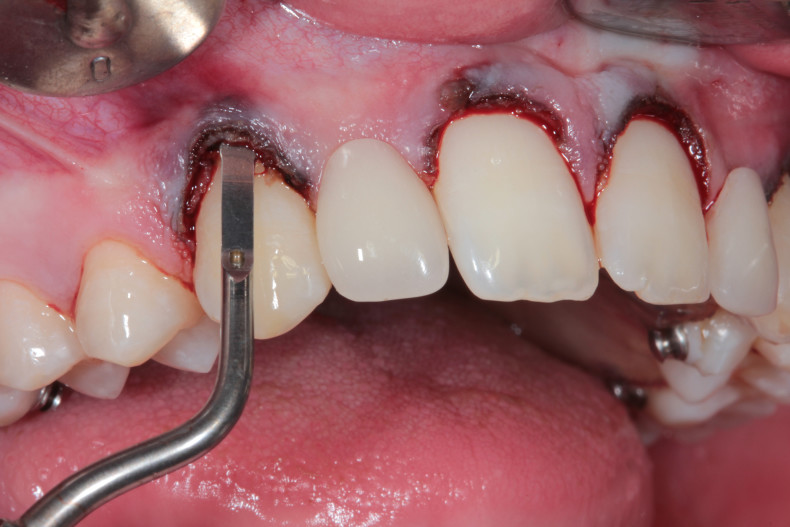 Minimalinvasive chirurgische Kronenverlängerung – ZWP online – das ...
