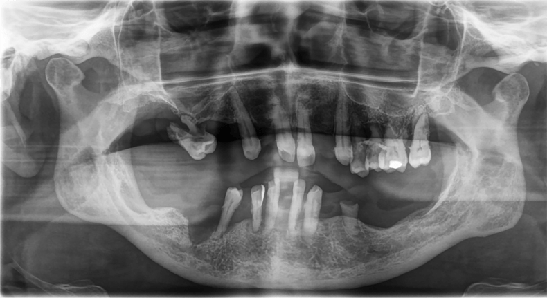 Teamwork in Prothetik, Chirurgie & Zahntechnik hilft Angstpatienten ...